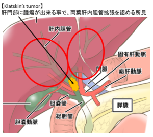 胆管癌（cholangiocarcinoma）