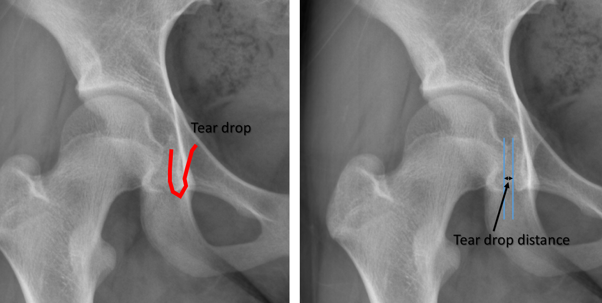 ペルテス病（Legg-Calve-Perthes disease）