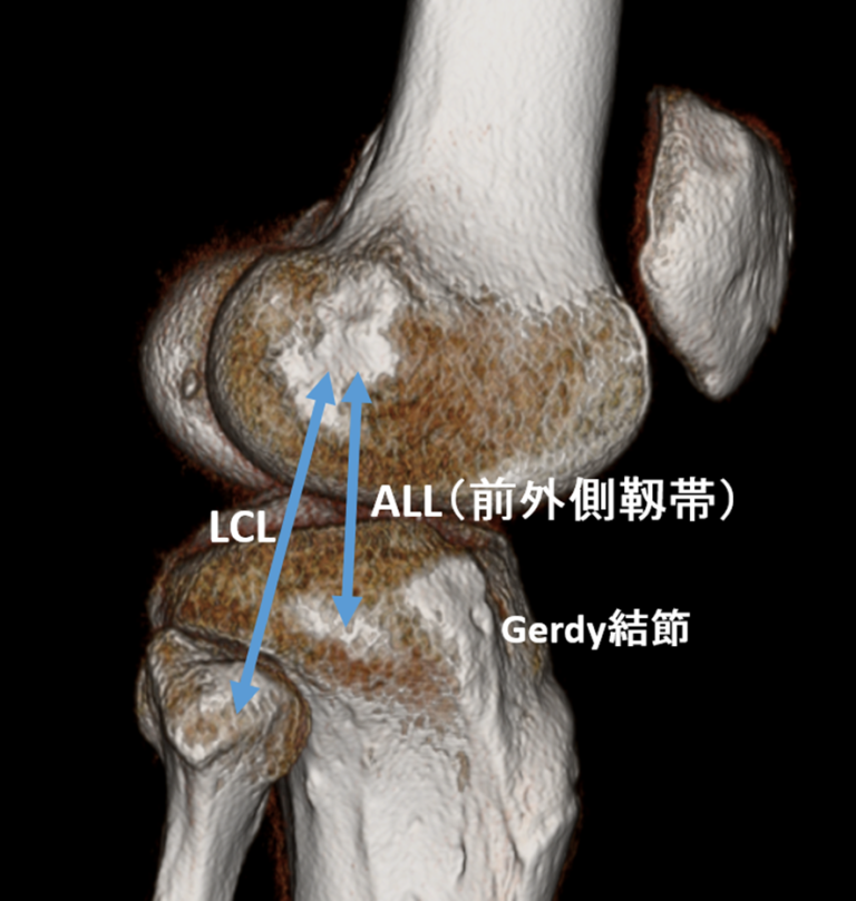 Segond骨折（Segond fracture）