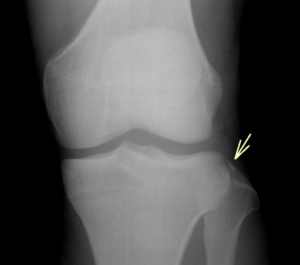 Segond骨折（Segond fracture）