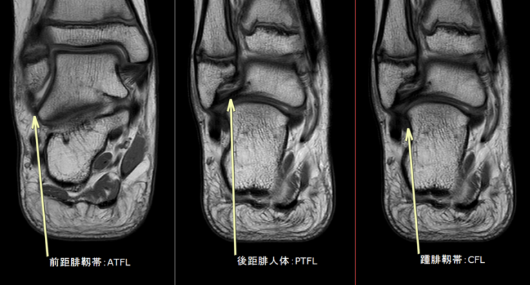 後脛骨筋腱断裂（tear of posterior tibial tendon）と前距腓靱帯（anterior talofibular ...