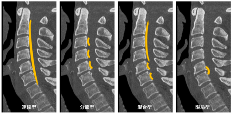 後縦靭帯骨化症（ossification of posterior longitudimal ligament：OPLL）