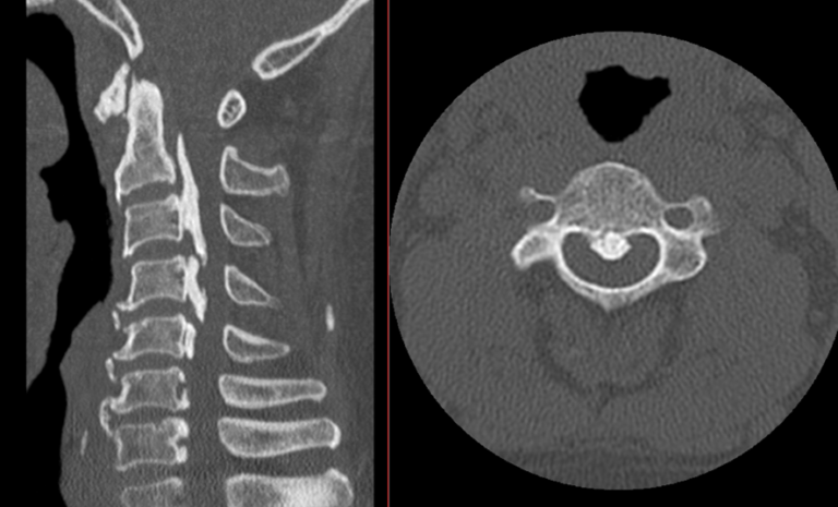後縦靭帯骨化症（ossification of posterior longitudimal ligament：OPLL）