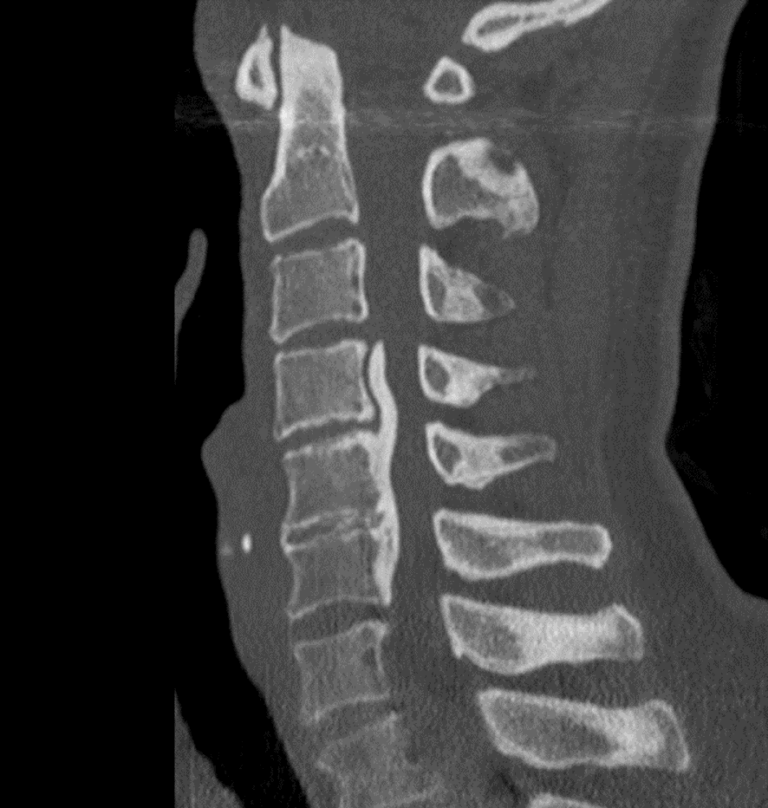 後縦靭帯骨化症（ossification of posterior longitudimal ligament：OPLL）
