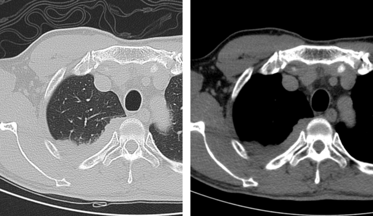 Pancoast腫瘍（Pancoast tumor）