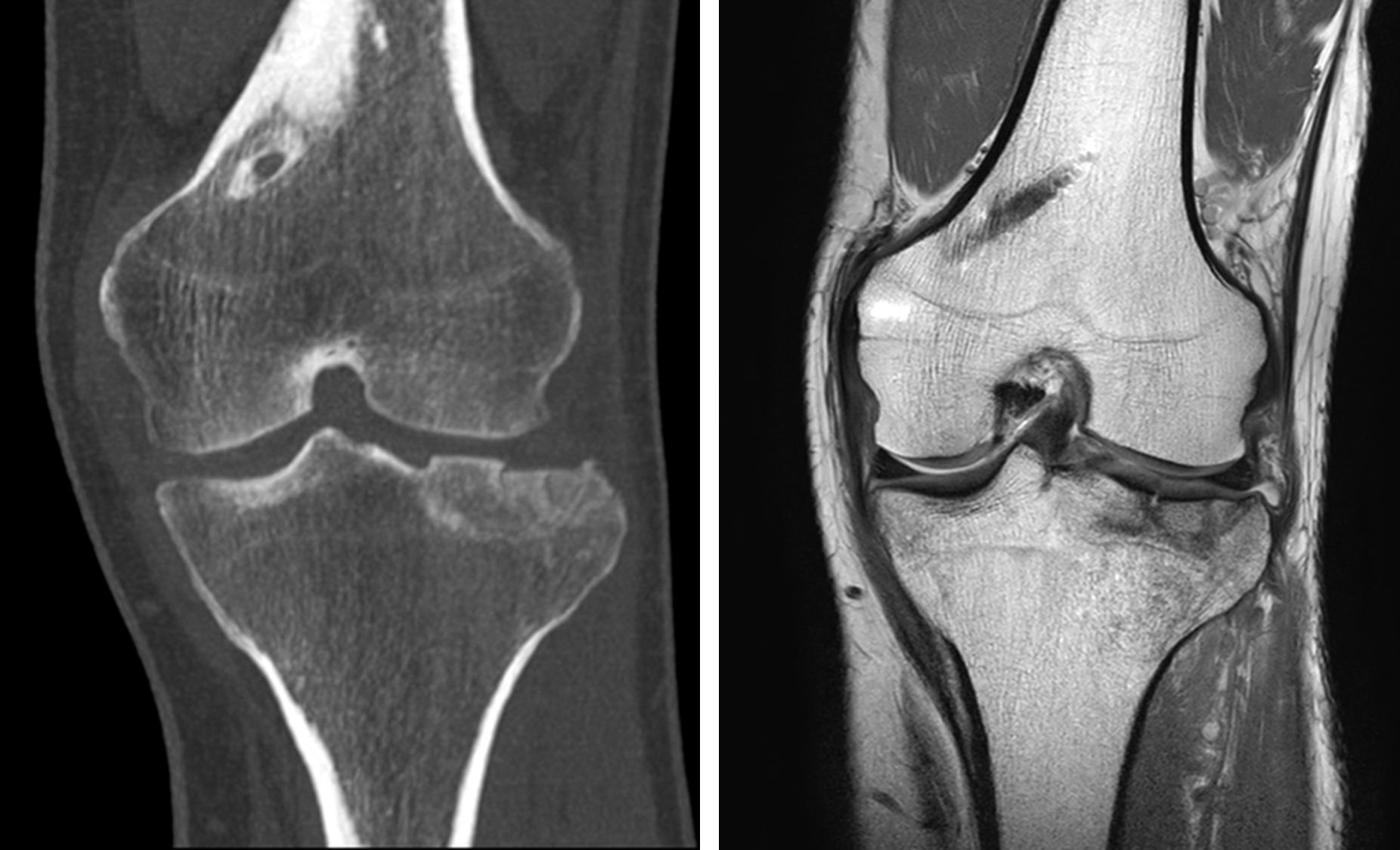 Segond骨折（Segond fracture）