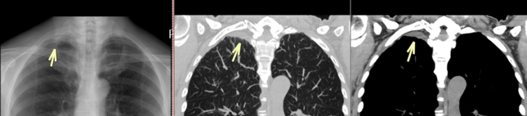 Pancoast腫瘍（Pancoast tumor）