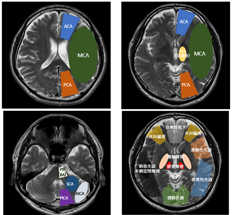 脳梗塞（cerebral infraction）