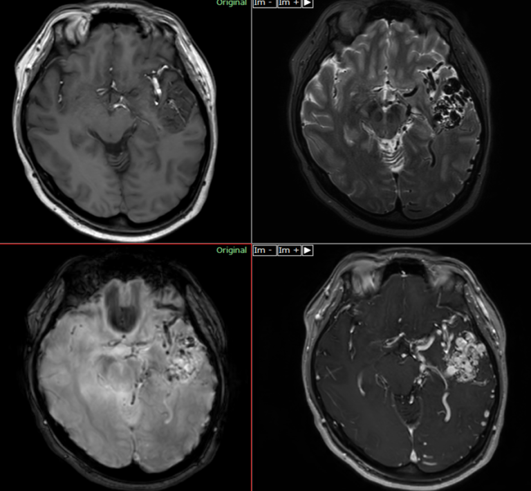 脳動静脈奇形（cerebral arteriovenous malformation：AVM）