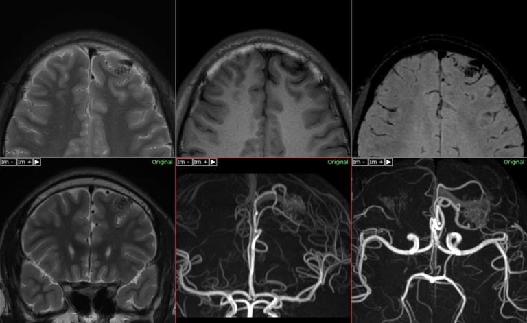 脳動静脈奇形（cerebral arteriovenous malformation：AVM）