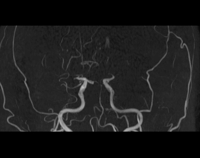 もやもや病（moyamoaya disease）