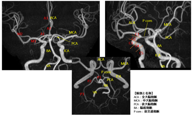 可逆性脳血管攣縮症候群（reversible cerebral vasoconstriction syndrome：RCVS）