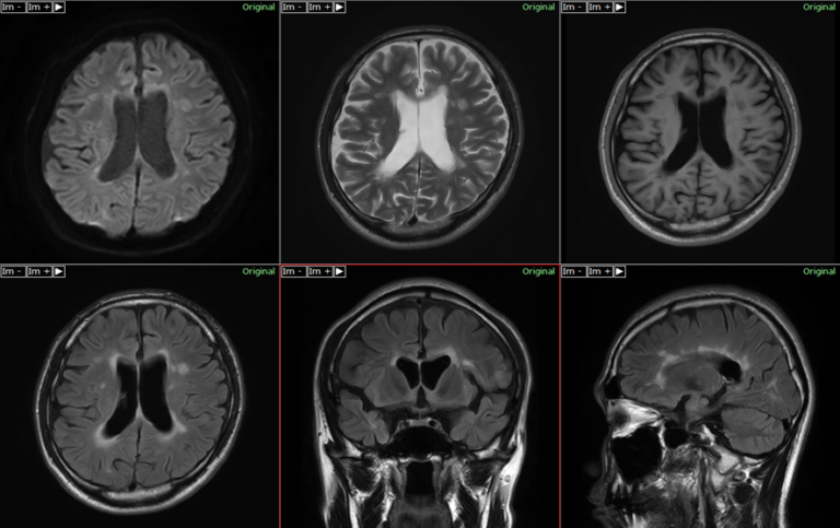 多発性硬化症（multiple sclerosis：MS）