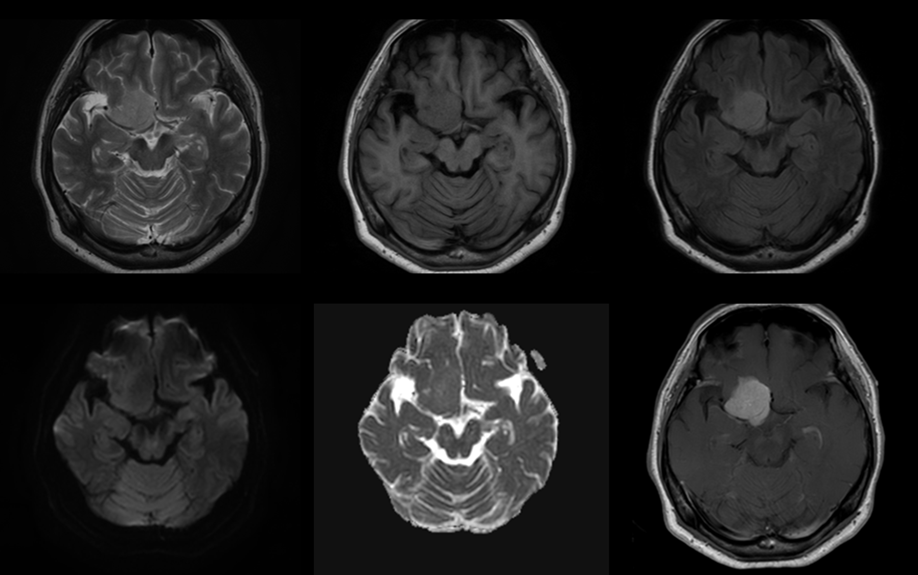 髄膜腫（meningioma）