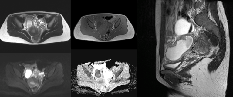 骨盤内感染症（pelvic inflammatory disease：PID）