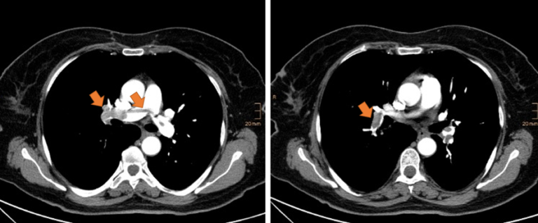 肺血栓塞栓症（pulmonary thromboembolism：PE）