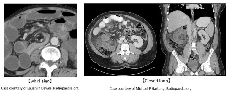 腸閉塞（bowel obstructiion）