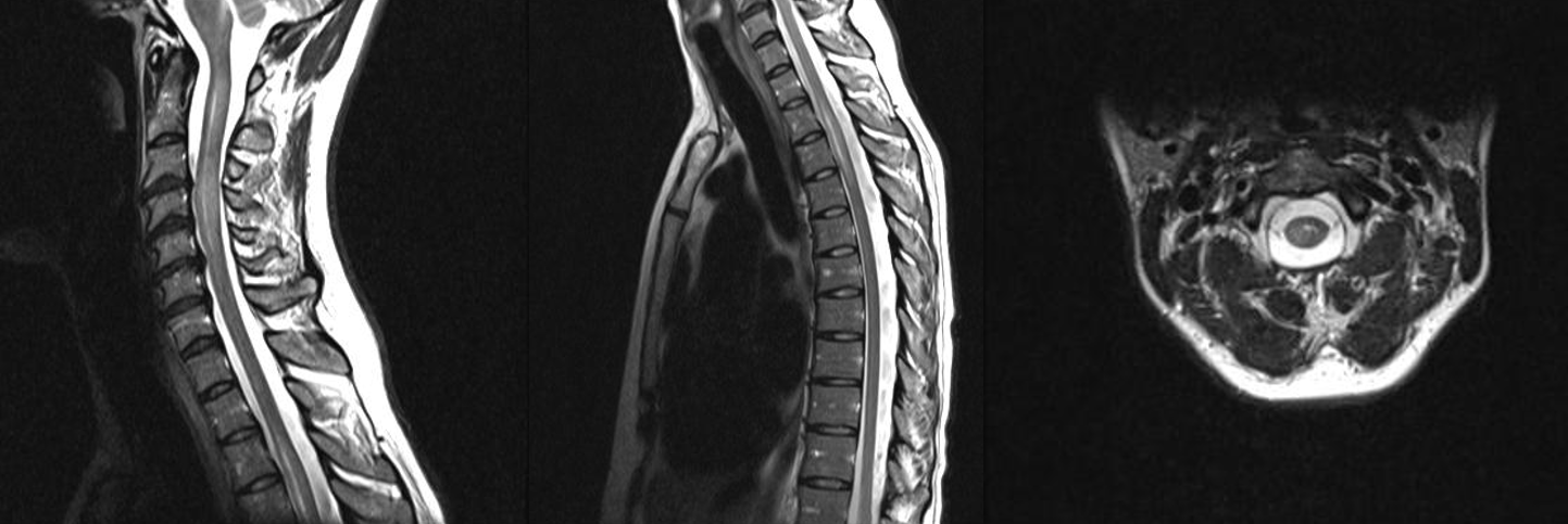 視神経脊髄炎関連疾患（neuromyelitis optica spectrum disorder：NMOSD）