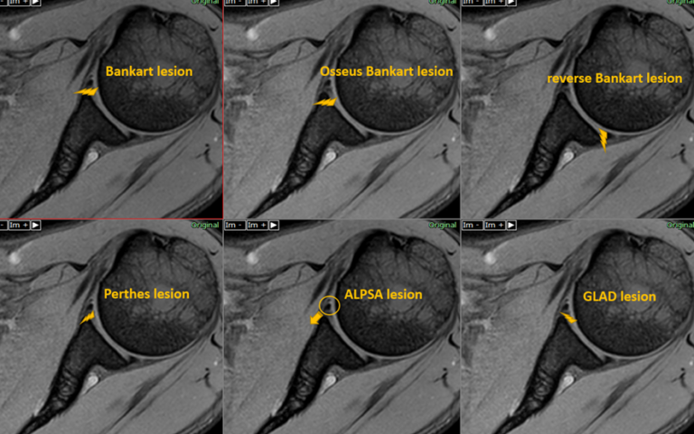 関節唇損傷（glenoid labrum and capsular injury）