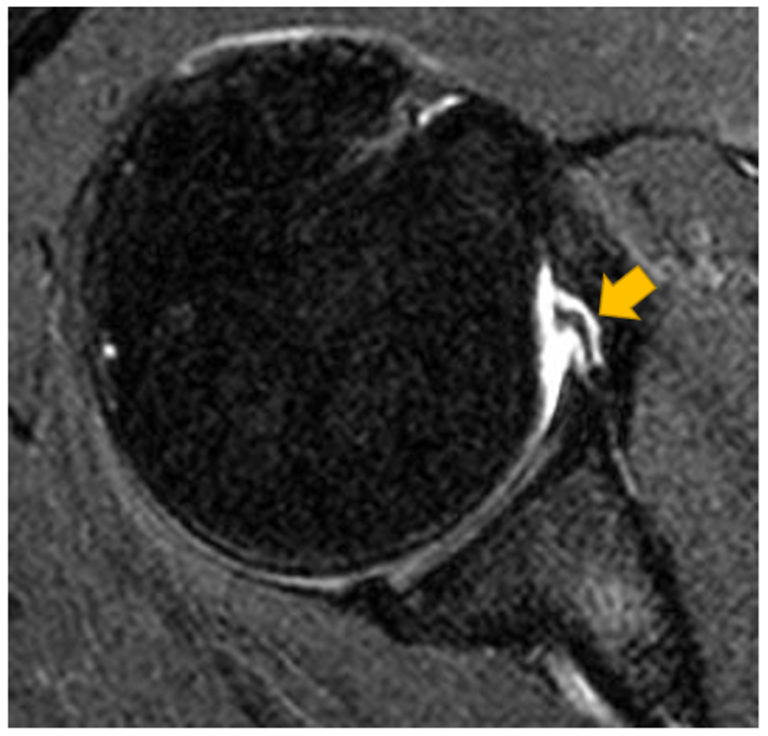 関節唇損傷（glenoid labrum and capsular injury）