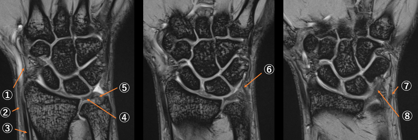三角線維軟骨複合体損傷（trianglar fibrocartilage complex：TFCC injury）