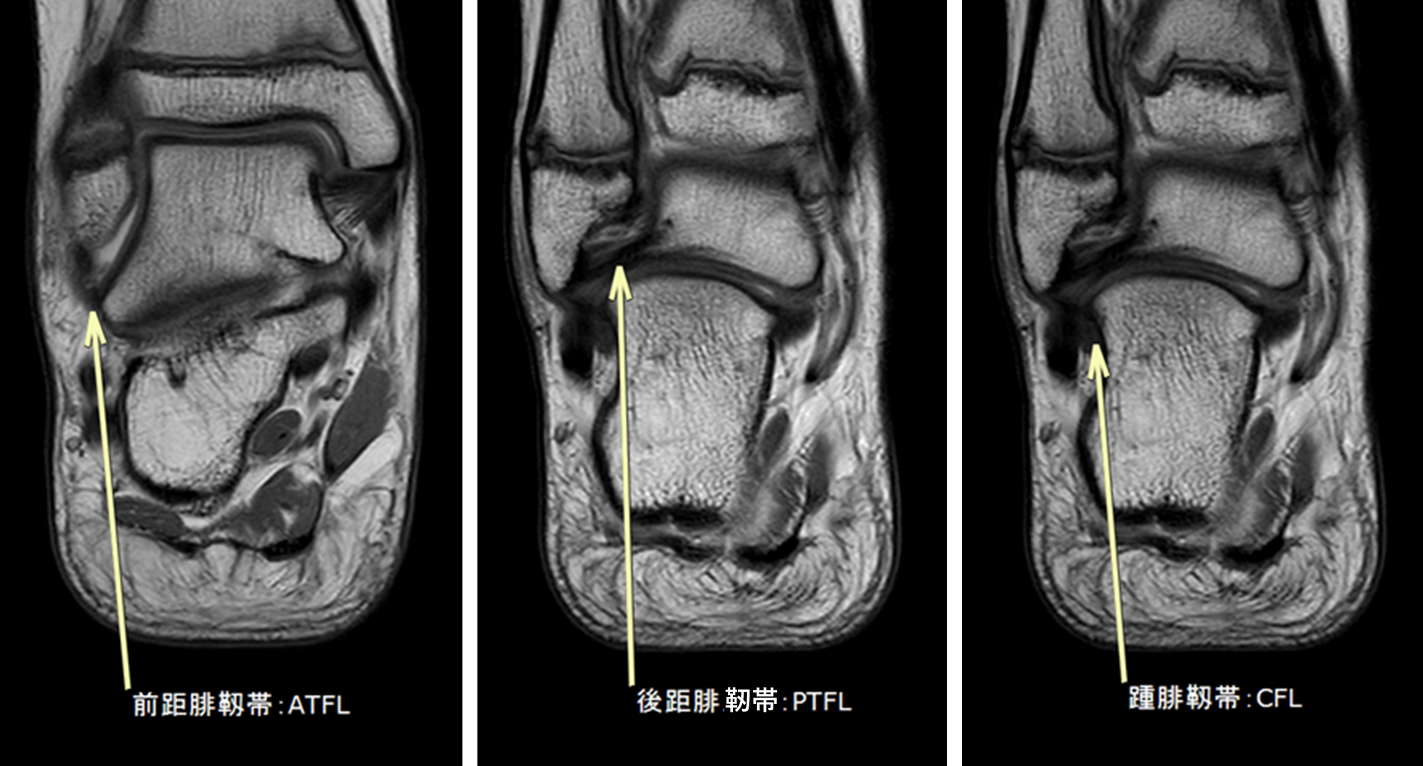前距腓靱帯（anterior talofibular ligament：ATFL）損傷