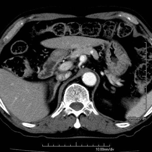 上腸間膜動脈閉塞症（superior mesenteric artery occlusion：SMA occlusion）