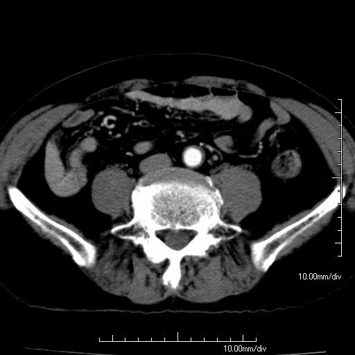 上腸間膜動脈閉塞症（superior mesenteric artery occlusion：SMA occlusion）